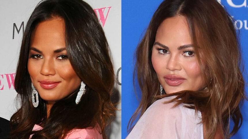 Chrissy Teigen Plastic Surgery, What Happened to Chrissy Teigen's Face ...